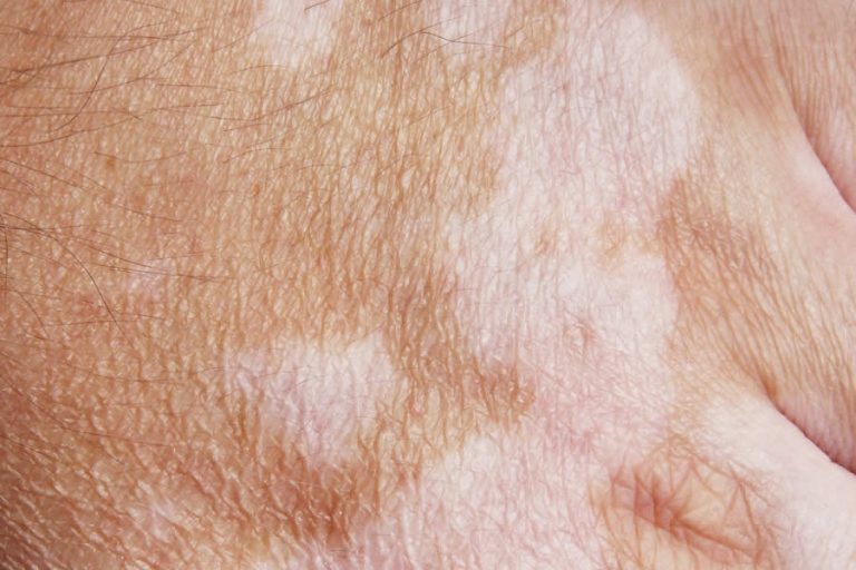 Manchas blancas en la piel ¿Es necesariamente vitíligo? - Abedul Farma